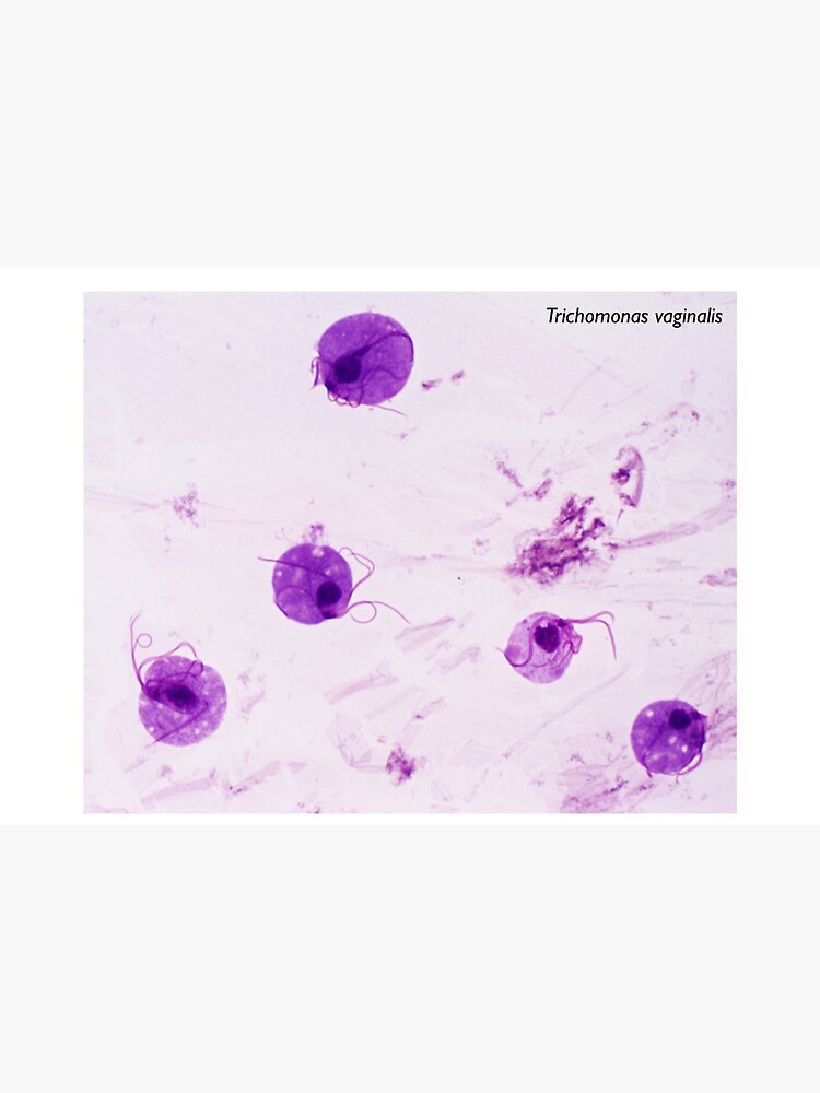 Strawberry Cervix Trichomonas