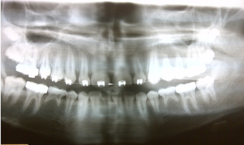 "teeth x-ray" by the-splinters | Redbubble