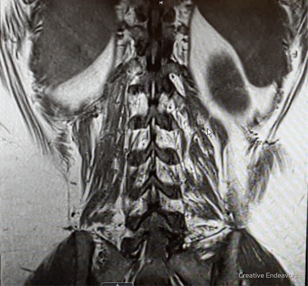 "Lumbar Lumbar Paraspinous Muscles with Lower Lungs, Liver and Spleen ...