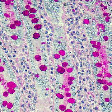 "Colon - PAS stain" Coffee Mug for Sale by Damien Harkin | Redbubble